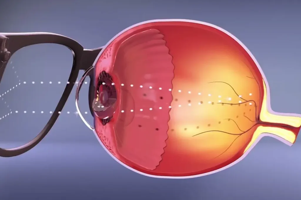 How Ortho K Lenses Work: Science Behind Reshaping the Cornea | The ...